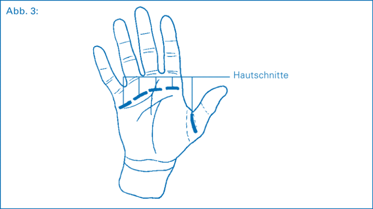 Schnappfinger & Sehnenscheidenentzündung – Freiburg, Baden-Württemberg ...