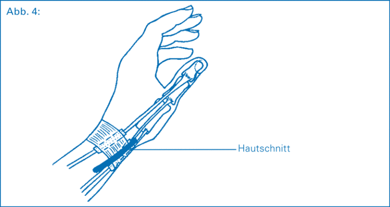 Tendovaginitis de Quervain – Freiburg, Baden-Württemberg – Chirurgie im ...